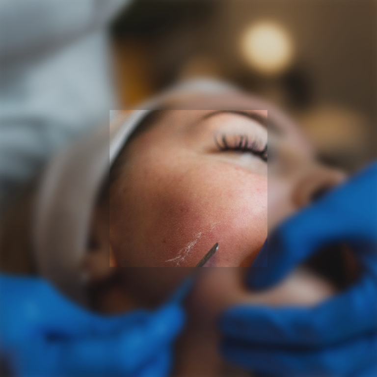 Vellus hair (peach fuzz) - Restore:Skin